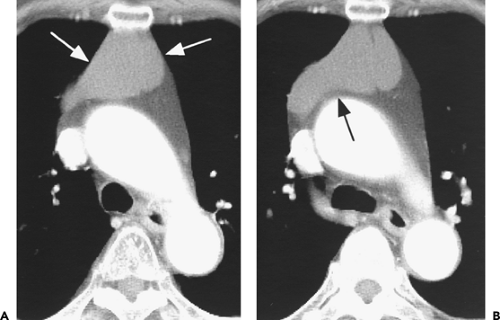 Mediastinum | Thoracic Key