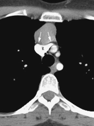 Mediastinum | Thoracic Key