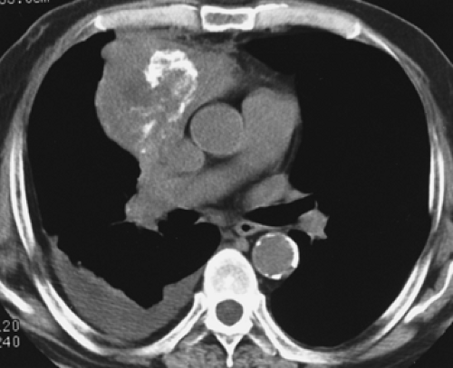 Mediastinum | Thoracic Key
