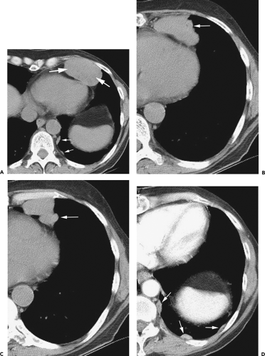 Mediastinum | Thoracic Key