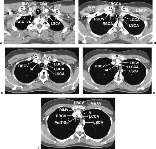 Mediastinum | Thoracic Key