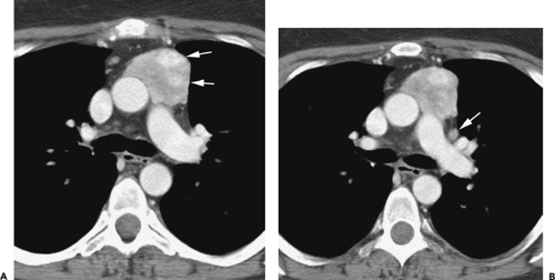 Mediastinum | Thoracic Key