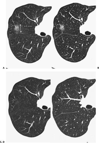 Focal Lung Disease | Thoracic Key