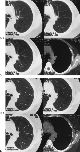 Focal Lung Disease | Thoracic Key