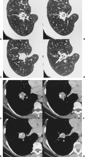 Focal Lung Disease | Thoracic Key