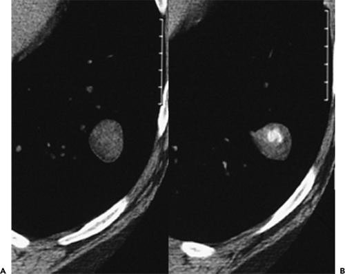 Focal Lung Disease | Thoracic Key