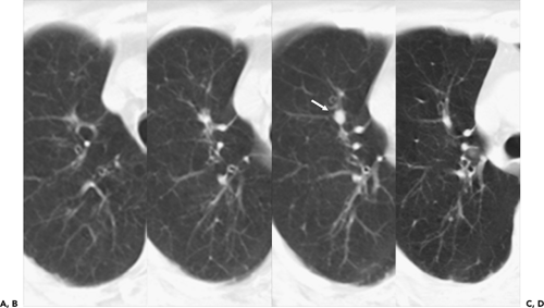 Focal Lung Disease | Thoracic Key