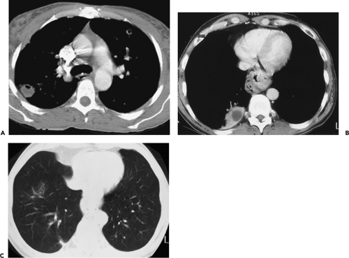 Focal Lung Disease | Thoracic Key