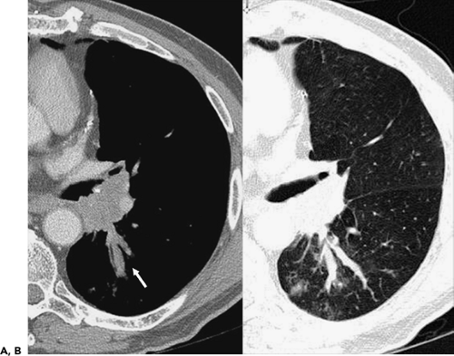 Focal Lung Disease | Thoracic Key