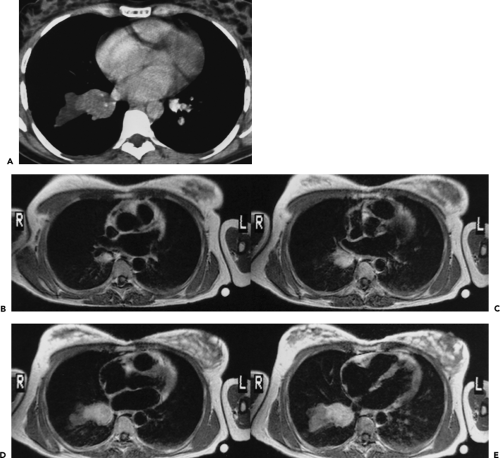 Focal Lung Disease | Thoracic Key