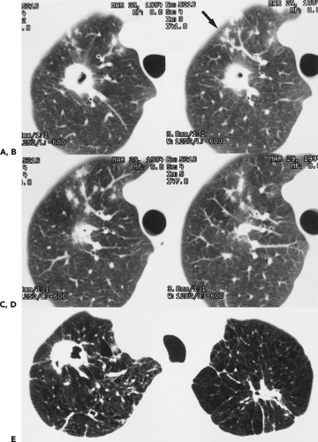 Focal Lung Disease | Thoracic Key