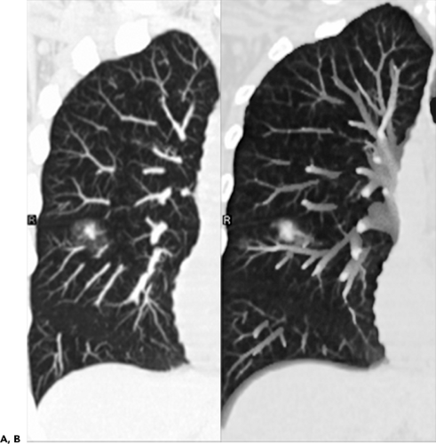 Focal Lung Disease | Thoracic Key