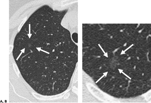Focal Lung Disease | Thoracic Key