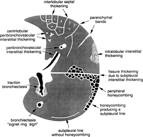 Diffuse Lung Disease | Thoracic Key