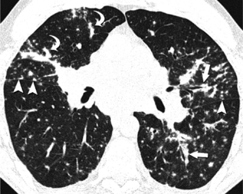Diffuse Lung Disease | Thoracic Key