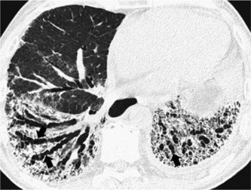Diffuse Lung Disease | Thoracic Key