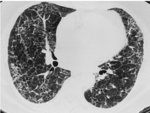 Diffuse Lung Disease | Thoracic Key