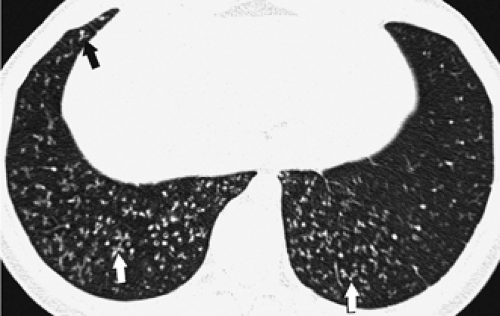 Diffuse Lung Disease | Thoracic Key