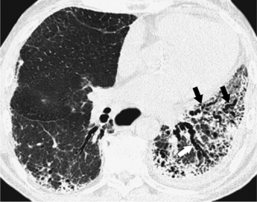 Diffuse Lung Disease | Thoracic Key