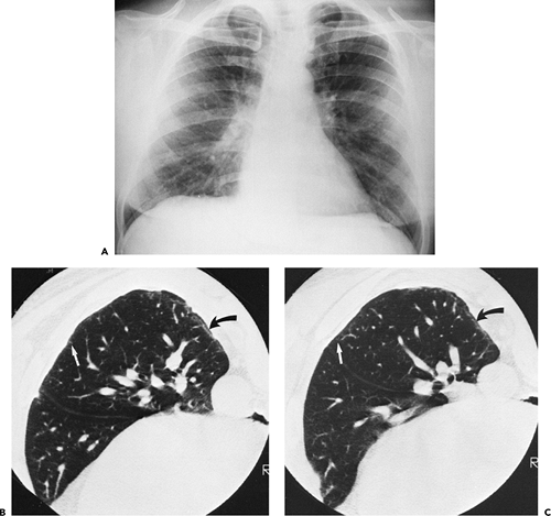 Diffuse Lung Disease | Thoracic Key