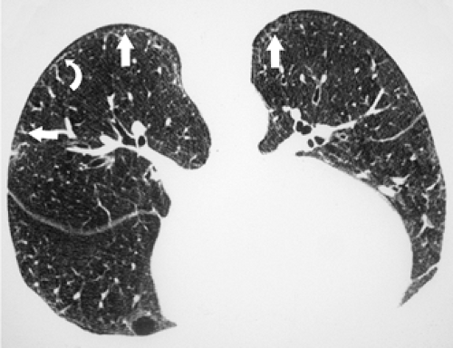 Diffuse Lung Disease | Thoracic Key