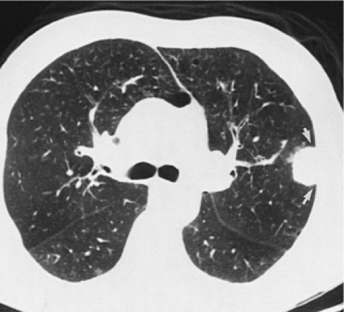 Pleura, Chest Wall, and Diaphragm | Thoracic Key