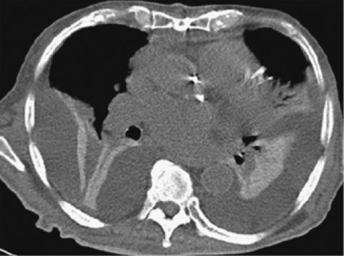 Pleura, Chest Wall, and Diaphragm | Thoracic Key