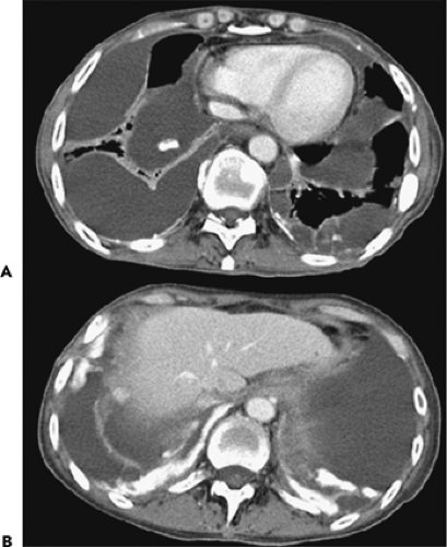 Pleura, Chest Wall, and Diaphragm | Thoracic Key