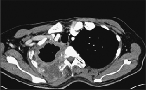 Pleura, Chest Wall, and Diaphragm | Thoracic Key