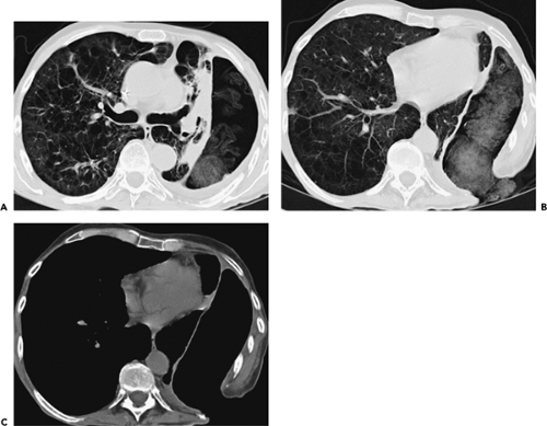 Pleura, Chest Wall, and Diaphragm | Thoracic Key