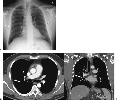 Pleura, Chest Wall, and Diaphragm | Thoracic Key