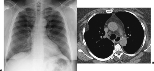 Pleura, Chest Wall, and Diaphragm | Thoracic Key