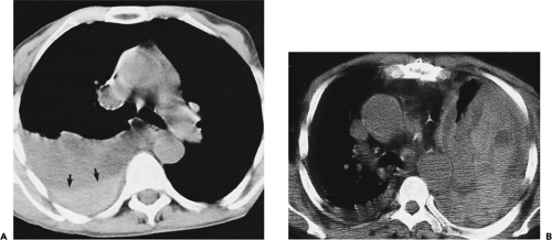 Pleura, Chest Wall, and Diaphragm | Thoracic Key