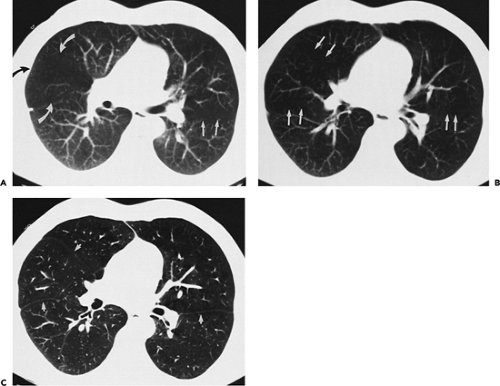 Pleura, Chest Wall, and Diaphragm | Thoracic Key