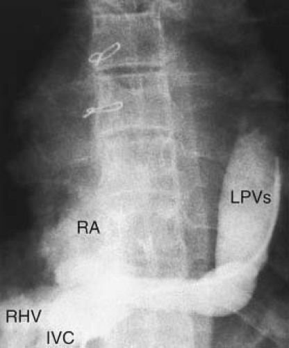 Anomalies of the Pulmonary Veins | Thoracic Key