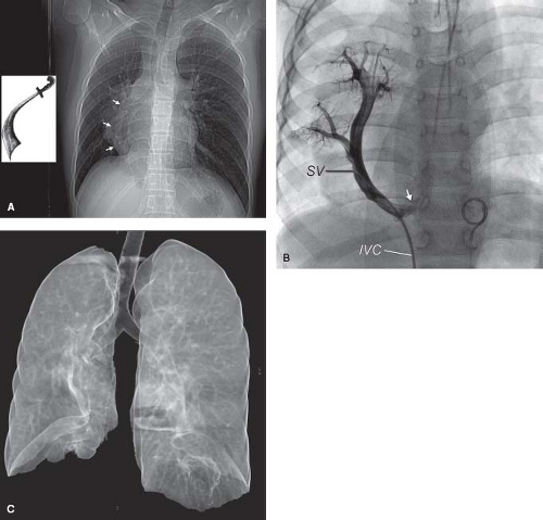 Anomalies of the Pulmonary Veins | Thoracic Key
