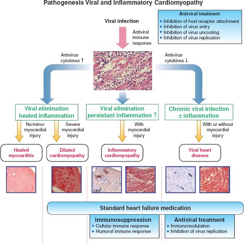 Myocarditis | Thoracic Key