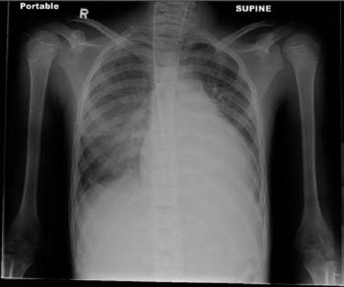 Myocarditis | Thoracic Key