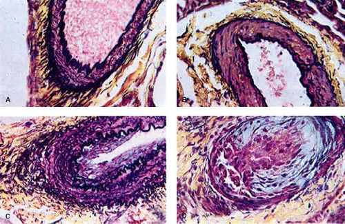 Pathophysiology of Pulmonary Hypertension | Thoracic Key