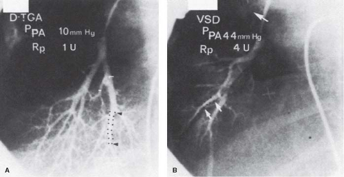 Pathophysiology of Pulmonary Hypertension | Thoracic Key