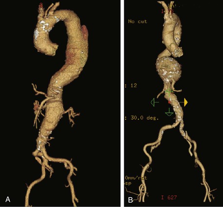 Thoracic and Thoracoabdominal Aortic Aneurysms | Thoracic Key
