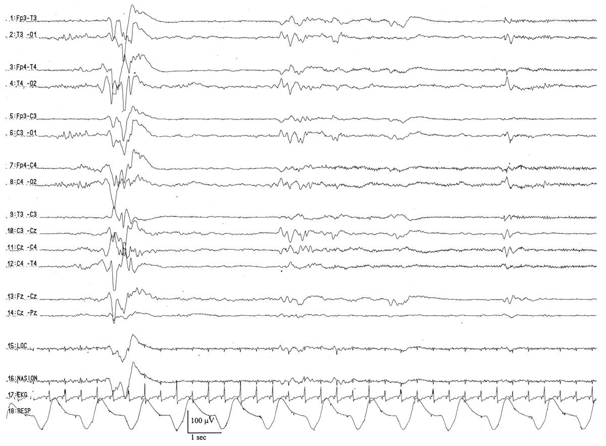 Normal Pediatric EEG: Neonates and Children | Thoracic Key