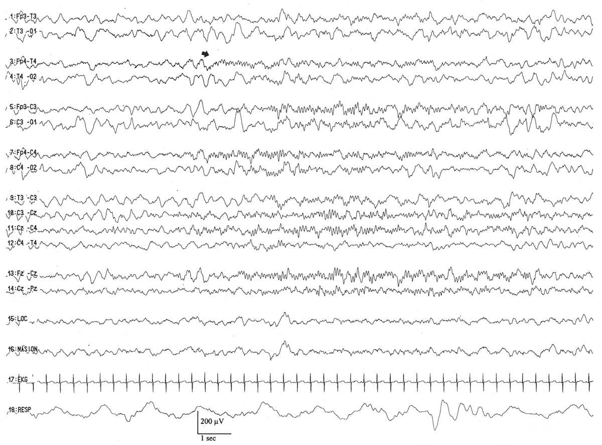 Normal Pediatric EEG: Neonates and Children | Thoracic Key