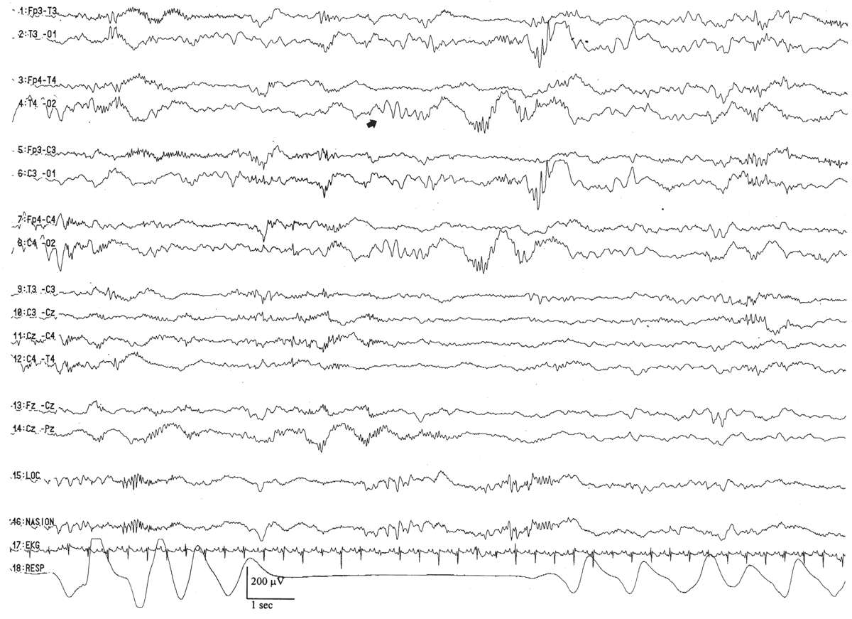 Normal Pediatric EEG: Neonates and Children | Thoracic Key