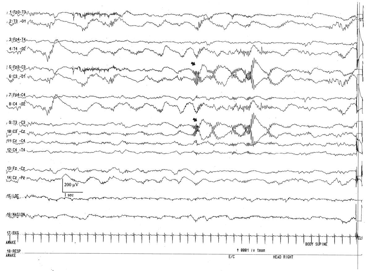 Normal Pediatric EEG: Neonates and Children | Thoracic Key