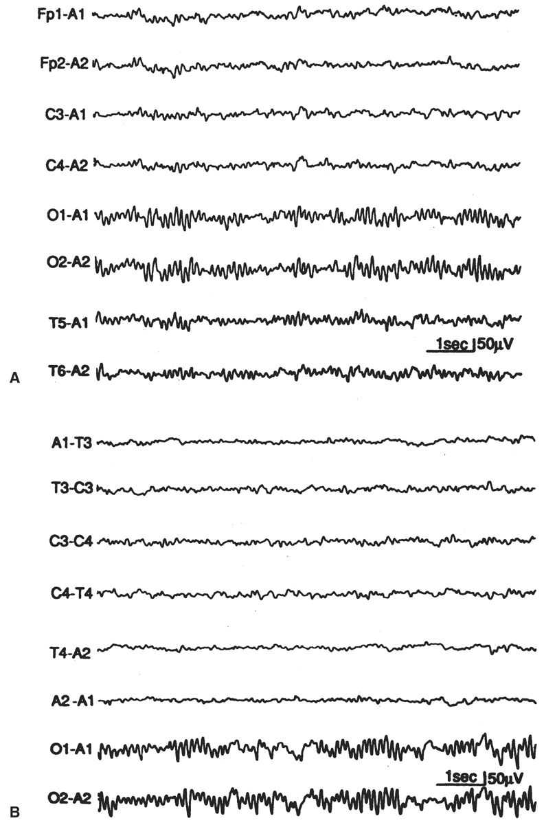 Normal Pediatric EEG: Neonates and Children | Thoracic Key