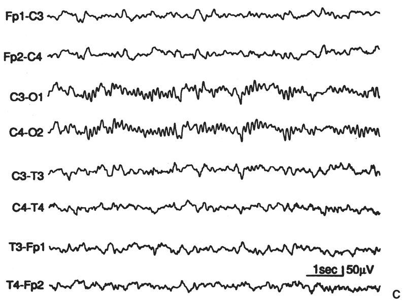 Normal Pediatric EEG: Neonates and Children | Thoracic Key