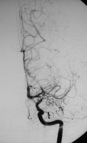 Occluded Internal Carotid Artery with Symptoms | Thoracic Key