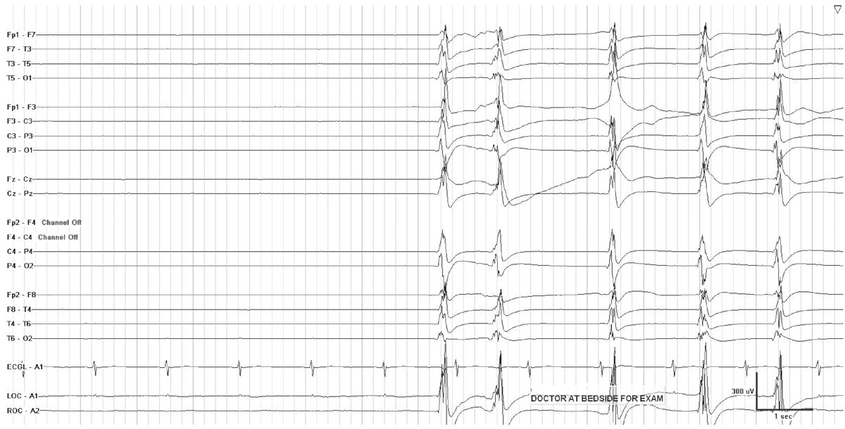 Generalized Encephalopathy | Thoracic Key