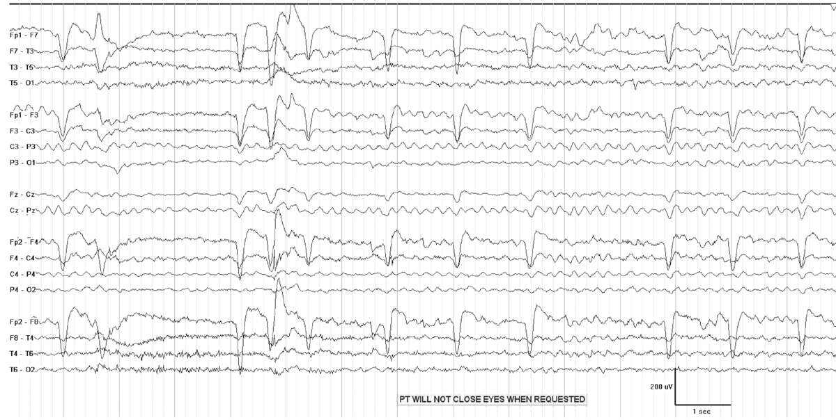 Generalized Encephalopathy | Thoracic Key